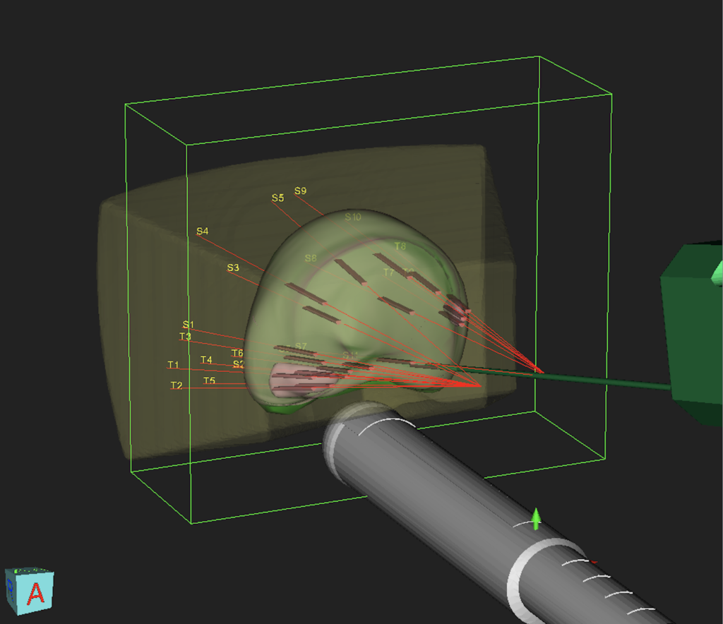 Robotic MR Fusion Prostate Biopsy - Uro Health Clinic
